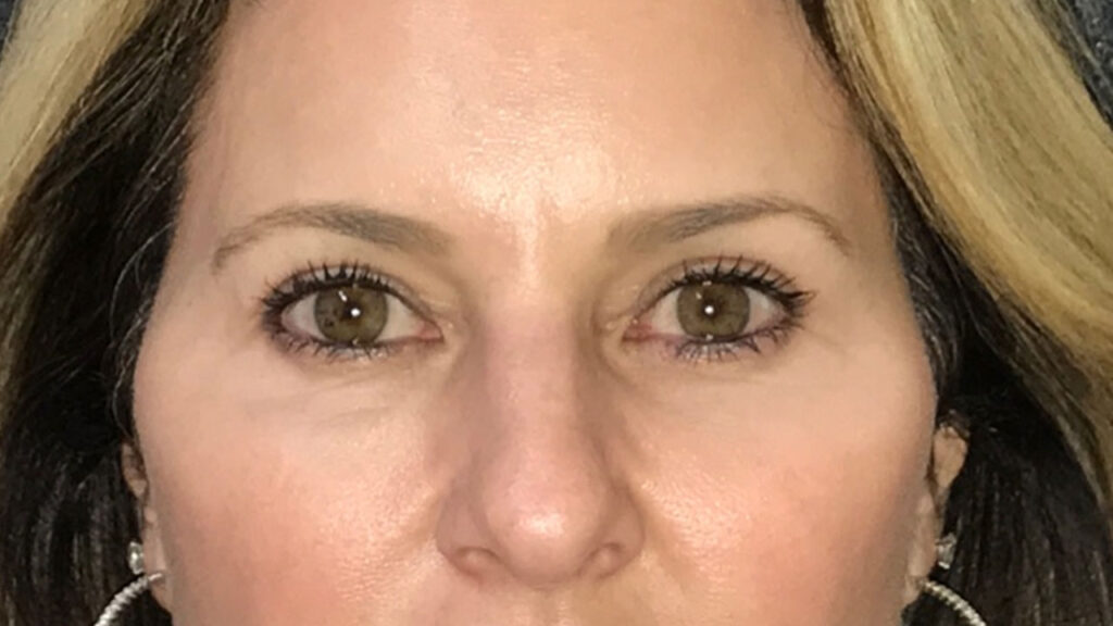Eyelid Surgery - MedSpa